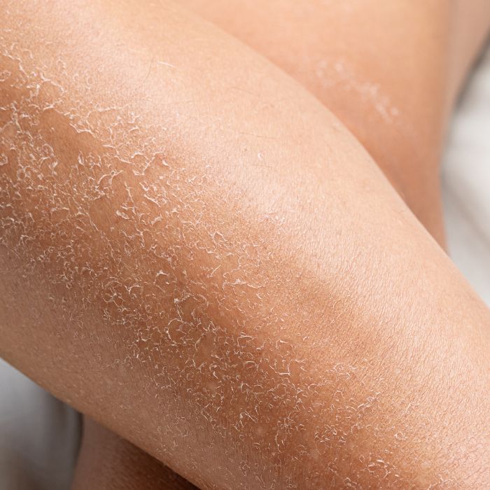 Comprendre la peau rugueuse et comment en prendre soin – Topicrem