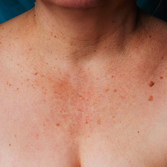 Tout savoir sur les hyperpigmentations de la peau – Topicrem